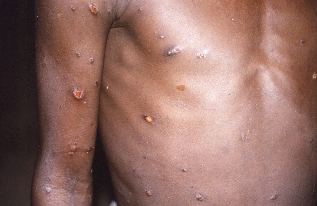 Explainer: Things you need to know about Monkeypox virus - Local Voices Liberia